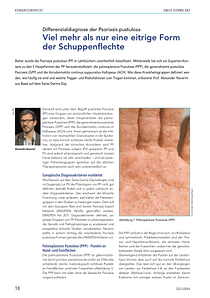 Differenzialdiagnose der Psoriasis pustulosa - Viel mehr als nur eine ...