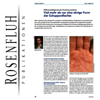 Differenzialdiagnose der Psoriasis pustulosa – Viel mehr als nur eine ...